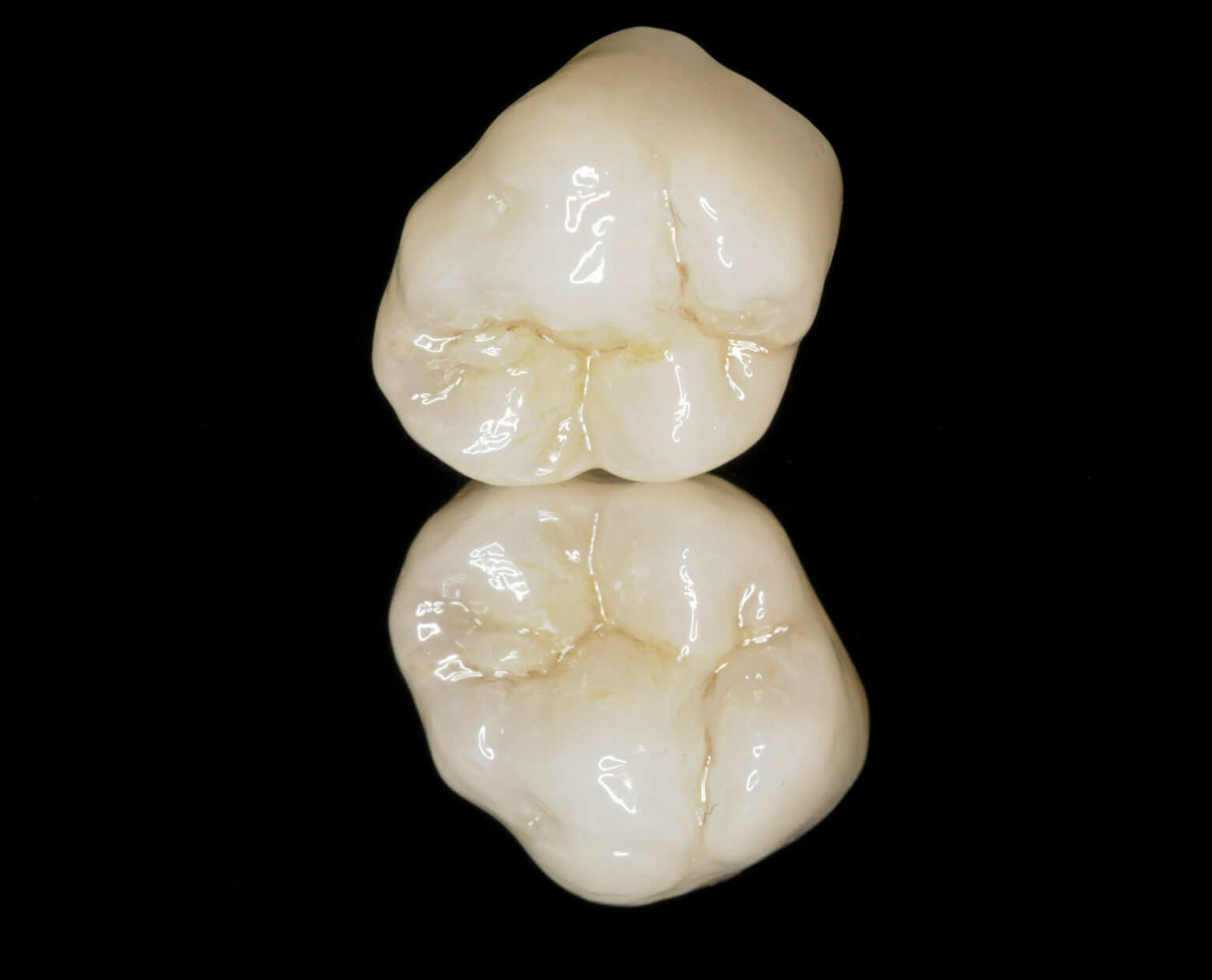 Couronne full zirone multicouche - SIVP DENTAIRE